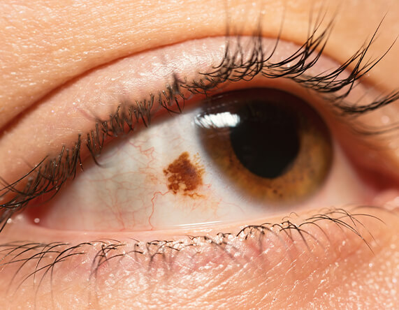 What Are Eye Freckles? - Eye Care - Your Trusted Eye Doctors in Eugene, OR What Are Eye Freckles? - Eye Care - Your Trusted Eye Doctors in Eugene, OR